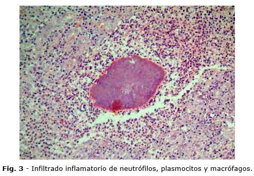 Actinomicosis faringolaríngea | Labrada Rodríguez | Revista Cubana de ...