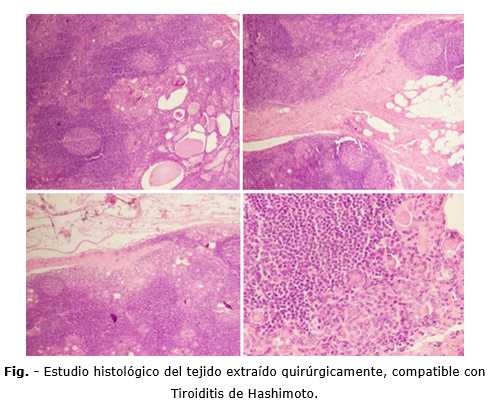 Tiroiditis de Hashimoto en tiroides aberrante | Contreras Álvarez ...