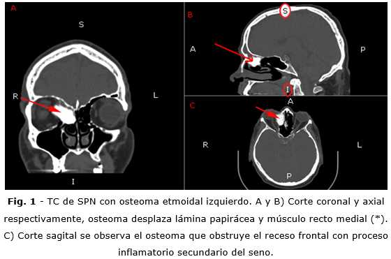 Resección endoscópica de osteoma etmoidal con extensión orbitaria ...