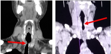 Estenosis traqueal post intubación prolongada | Narváez Almeida ...