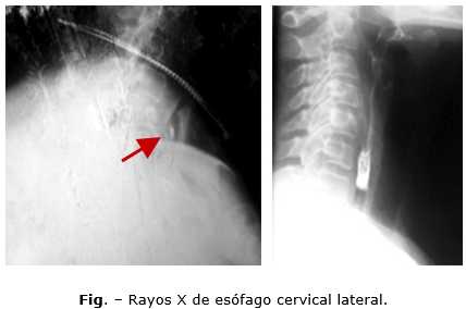 Cuerpo extraño en esófago | Hernández Montero | Revista Cubana de ...